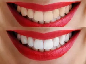 آپ کے دانتوں کو کس طرح حاصل کرنے کے لئے: آپ کے دانتوں کو نقصان کے بغیر گھر میں کس طرح پہننے کے لئے؟
